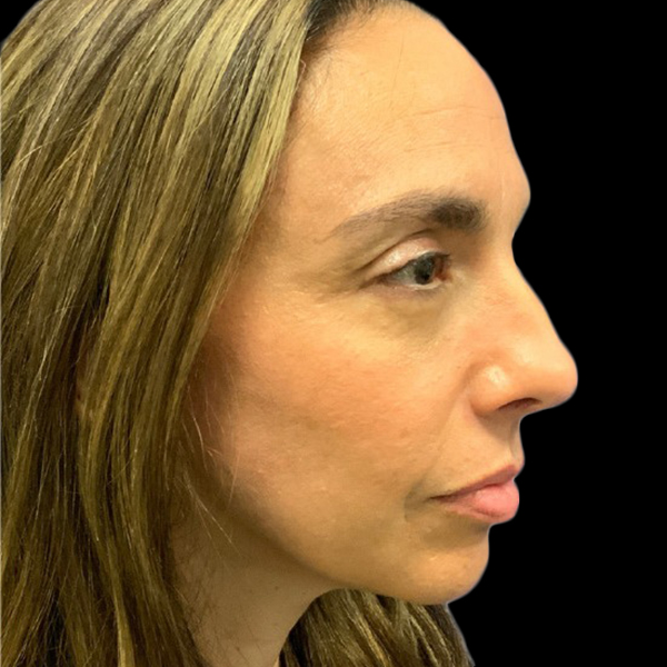 Best Facelift for Men in Long Island & NYC | Greenberg Cosmetic Surgery